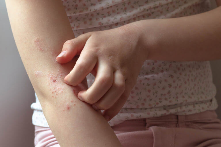 Happy Skin Pediatric Dermatology | Phoenix Eczema Specialist