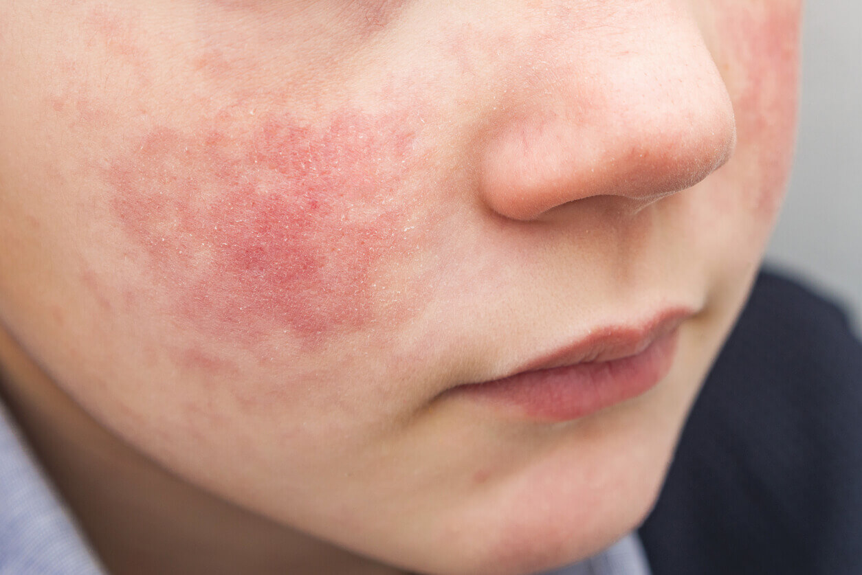 What Causes Eczema on the Face? - Happy Skin, PLLC