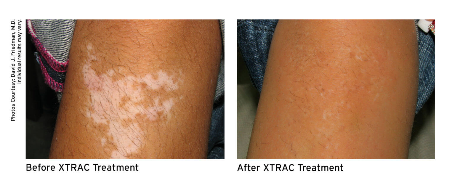 XTRAC Laser Phoenix, AZ | Xtrac for Psoriasis & Vitiligo Treatment