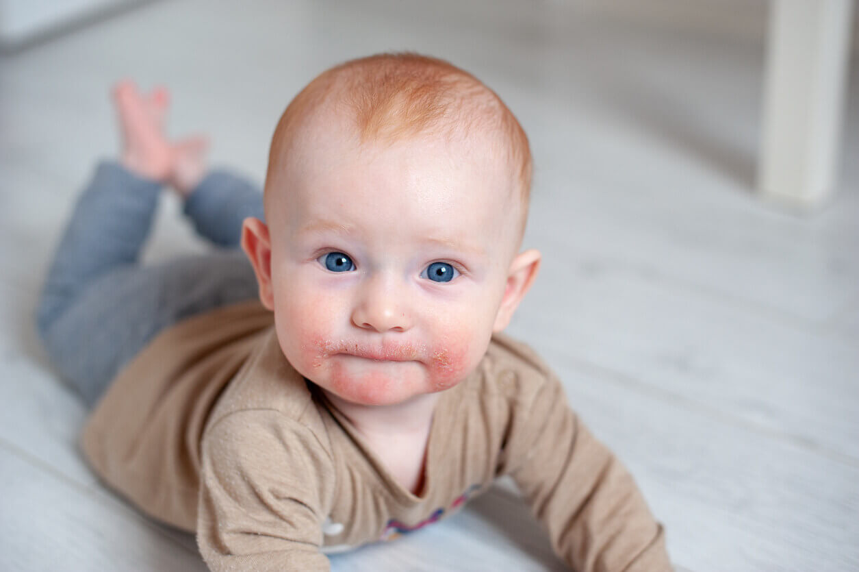 Newborn Eczema: Early Signs | Happy Skin Pediatric Dermatology