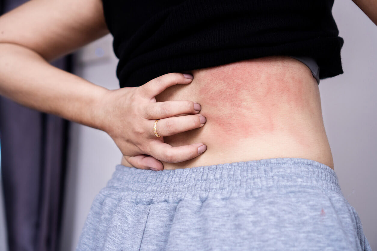 Itch Relief Strategies for Atopic Dermatitis and Other Skin Conditions